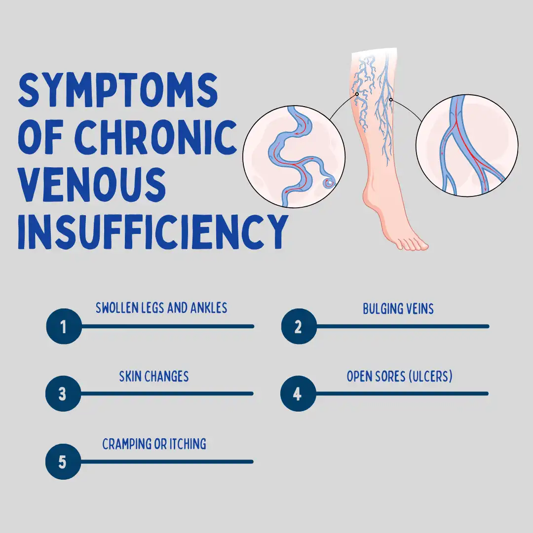 Venous Disease - AAVC - Asian Aortic & Vascular Centre